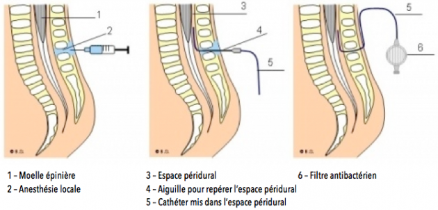 10 Questions Réponses sur l'anesthésie Péridurale à l'accouchement