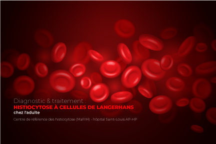 diagnostic-et-le-traitement-de-l’Histiocytose-à-cellules-de-Langerhans ...